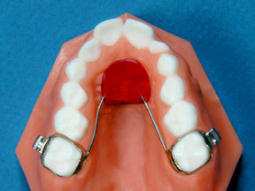 Orthodontic Appliances